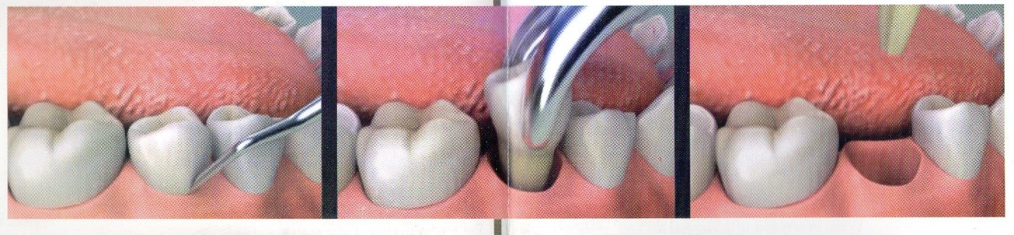 Tooth Extraction - Deep Dental Clinic And OPG Centre