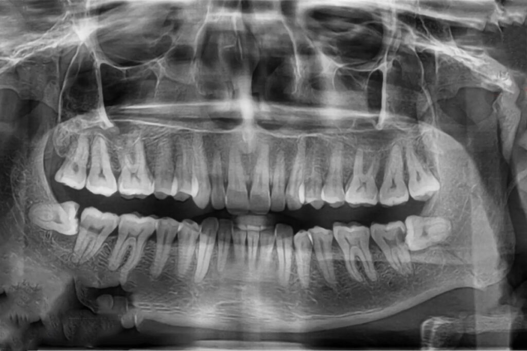 OPG-2D Scan | Deep Dental Clinic | 9464964543
